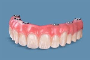Prótese Protocolo - Clínica Cia do Sorriso - Blumenau/SC 1